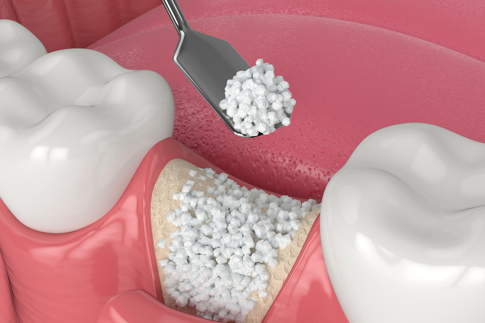 Dental Bone Graft Healing Timeline: Key Stages Explained